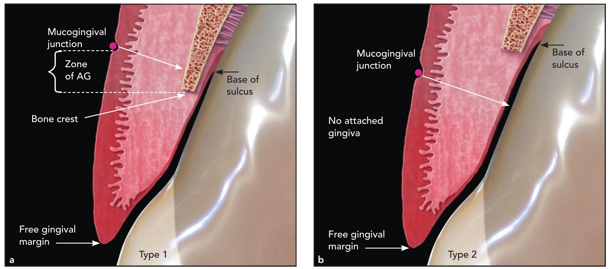 Infrabony defect on a tooth. the mgj is apical to the bone