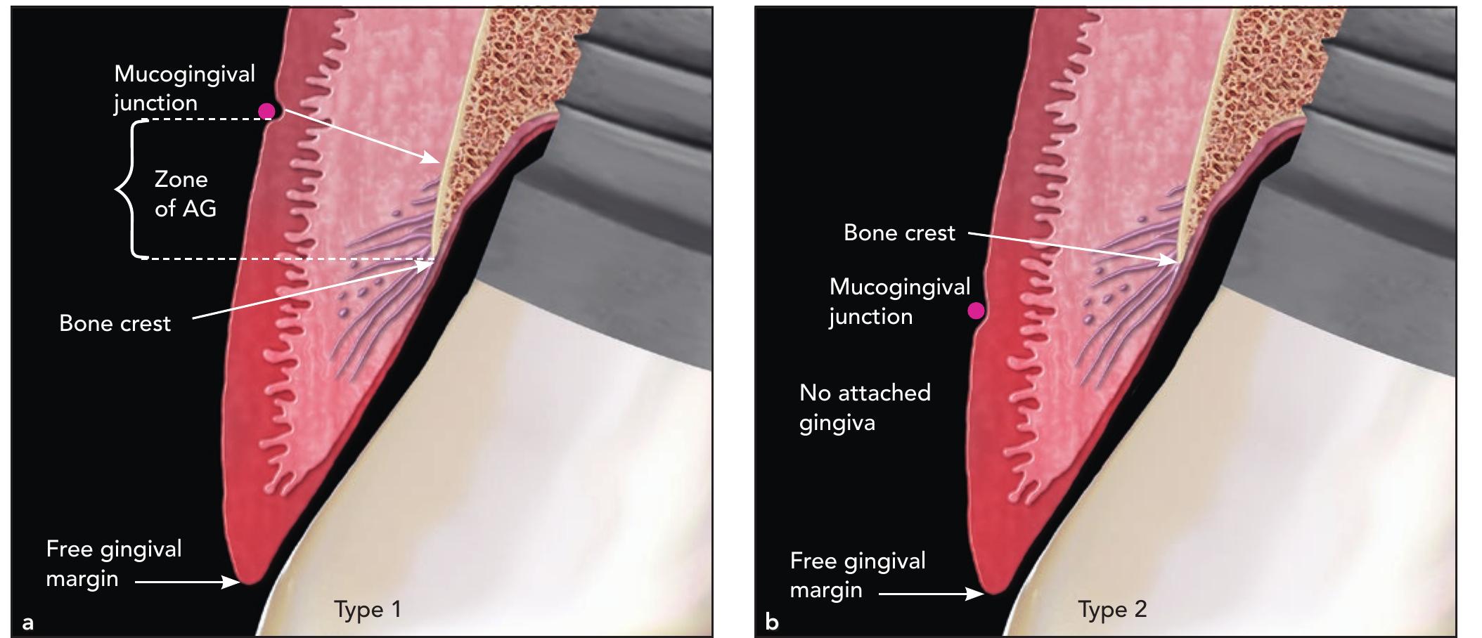 Peri-implantitis on bone-level implants. (a) type 1. the mgj
