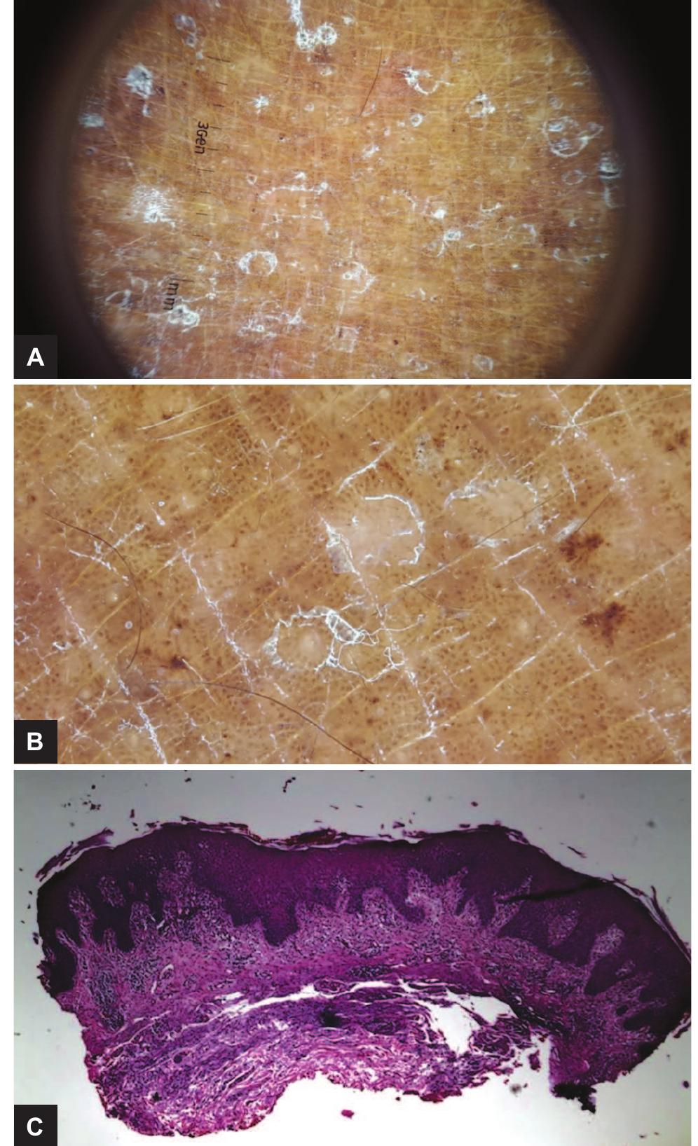 S 2a to c: (a) dermoscopy of case 1 exhibiting ring scales;