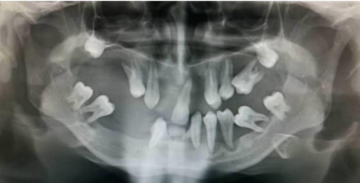 ‘ig. 3: opg shows extensive loss of alveolar bone with