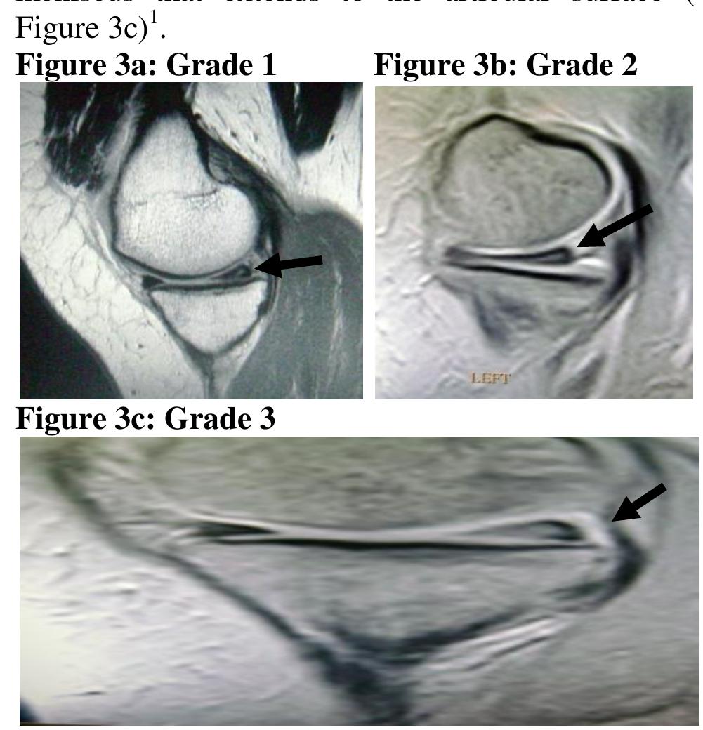A,b,c shows grades of meniscal tear. on mri we can easily