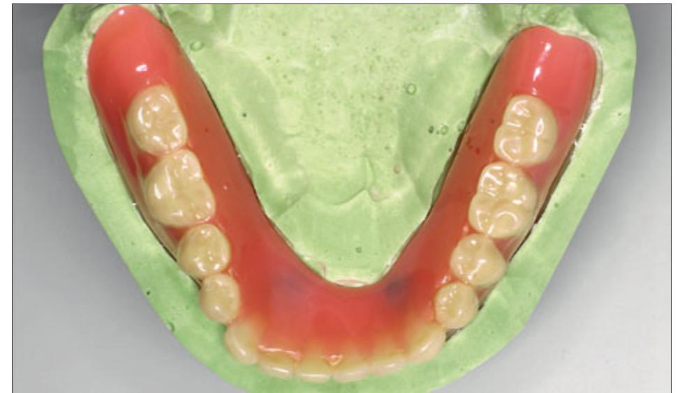 Maxillary denture, occlusal view.