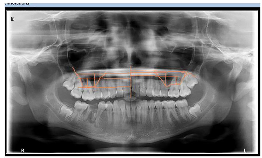 3.1. sample characteristics the carestream (cs) r4 software