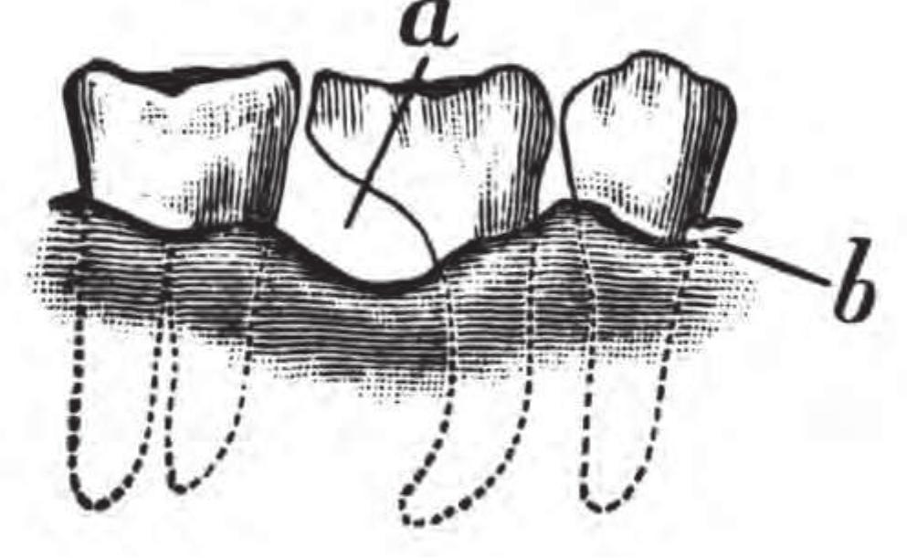 Diagram of root resection on a mandibular molar as advocated