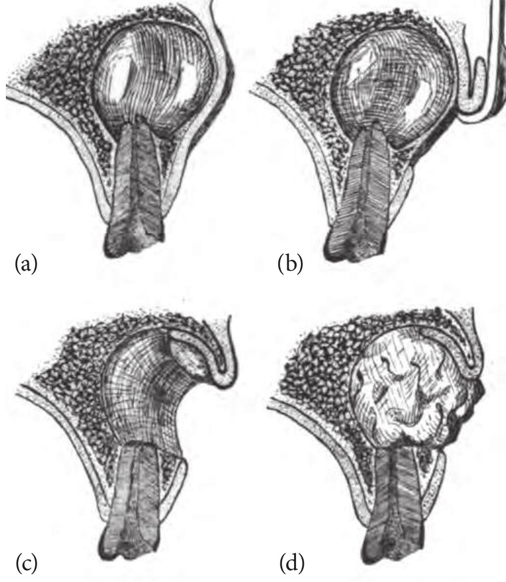 Schematic drawing of cyst management according to prinz. (a)