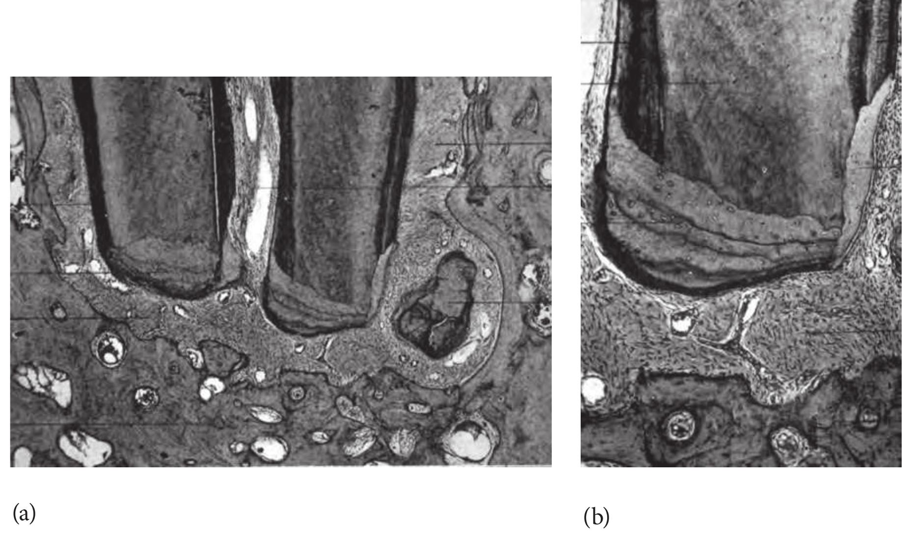 (a) fractured roots of mandibular central incisors. note the