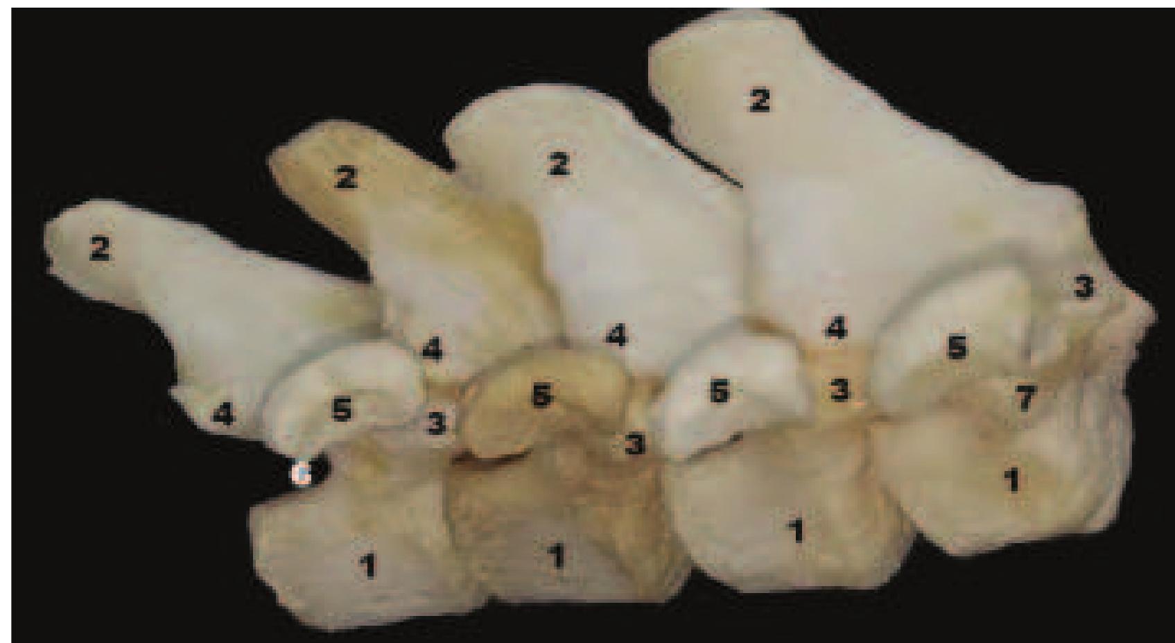 Lateral view of the first 3 thoracic vertebrae. (1) body,