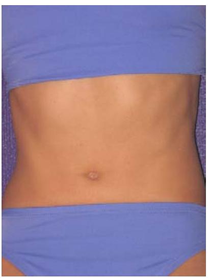 Abdominal bracing. the abdominal bracing technique involves