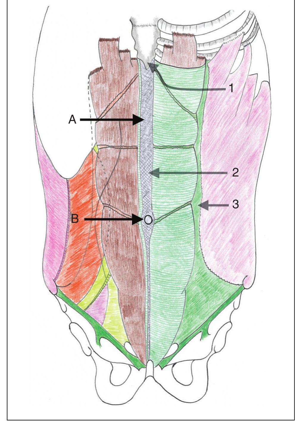 A, epigastric hernia; b, umbilical hernia; 1, xiphoid