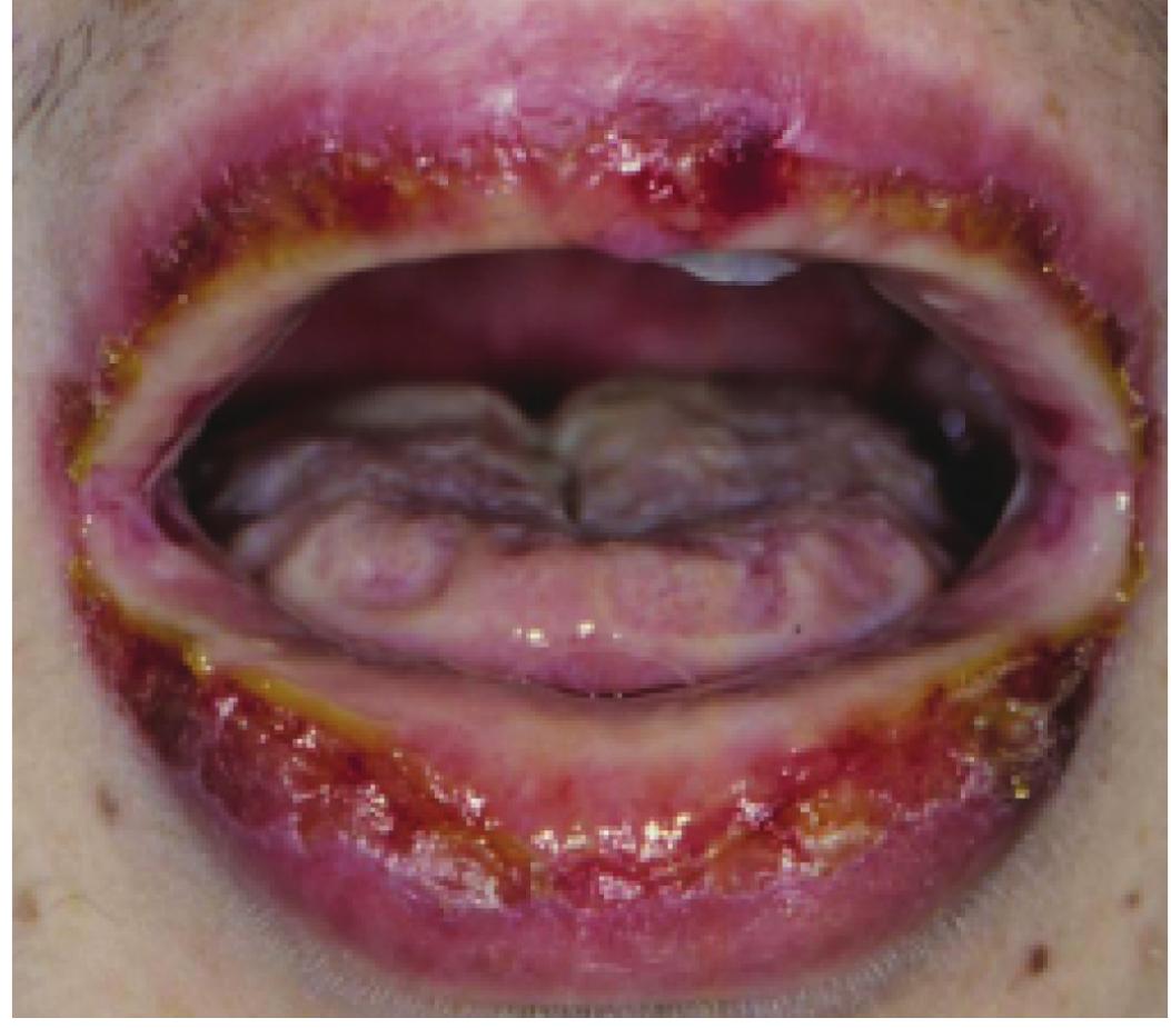 Hemorrhagic erosions of lips and oral cavity in erythema