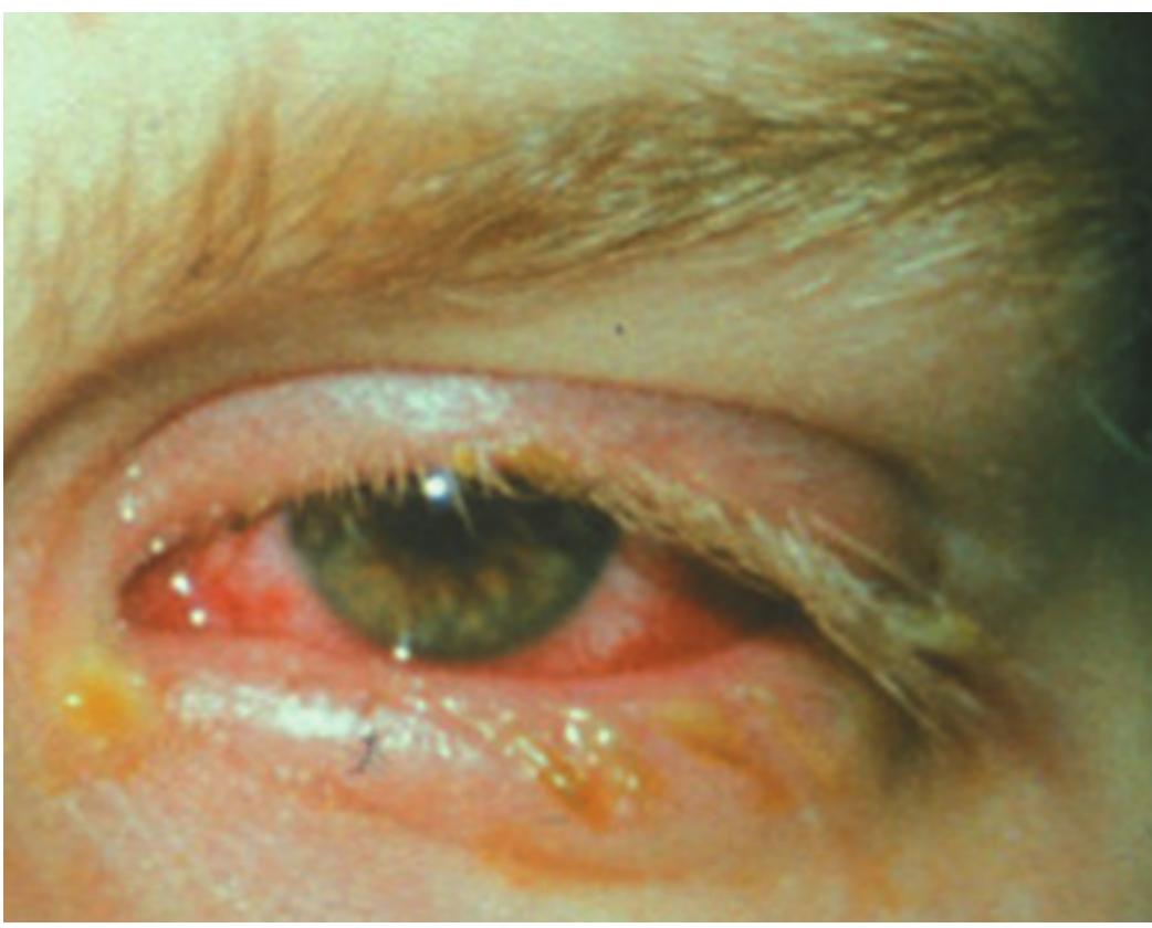 Severe eye involvement in erythema multiforme majus,