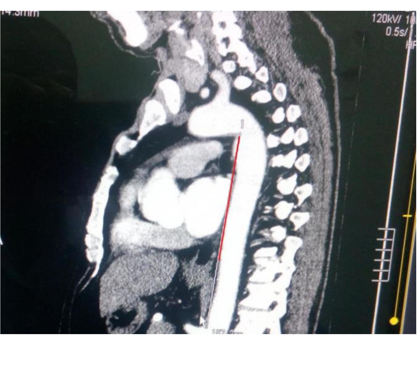 Figure 33 - Measurement of Normal Diameter of Thoracic Aorta