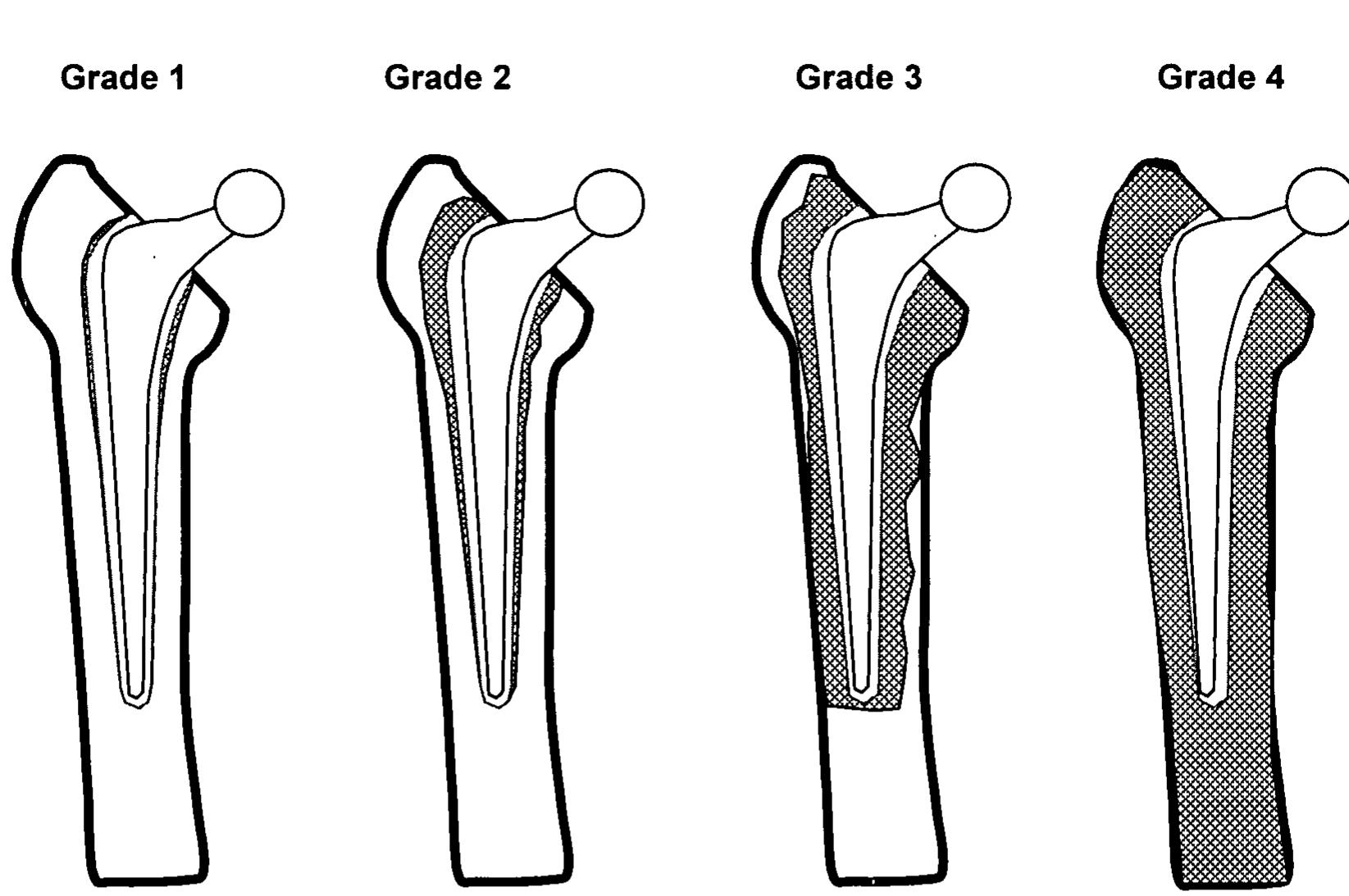 2: endo-klinik classification for femoral bone stock loss.