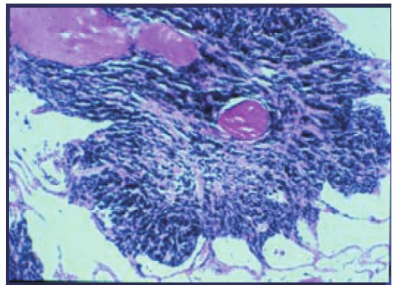 Igure 7 microscopic examination of lymph node showing
