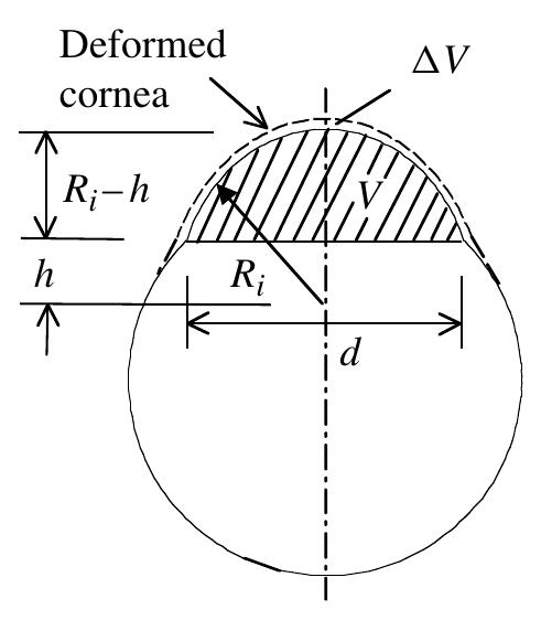 Schematic diagram for the distension of the eye with the