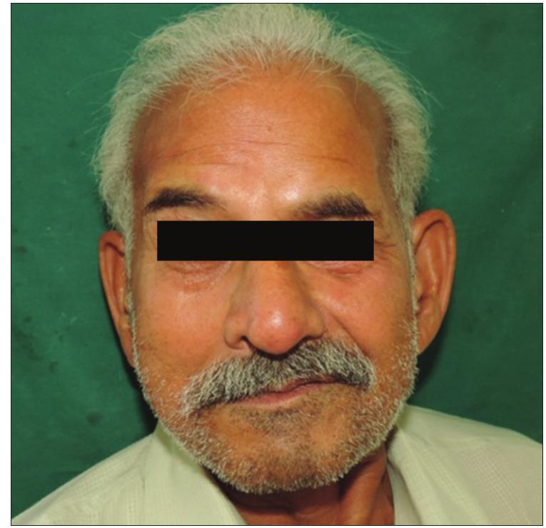 Pre-treatment view: asymmetry of the face. 6 months prior on