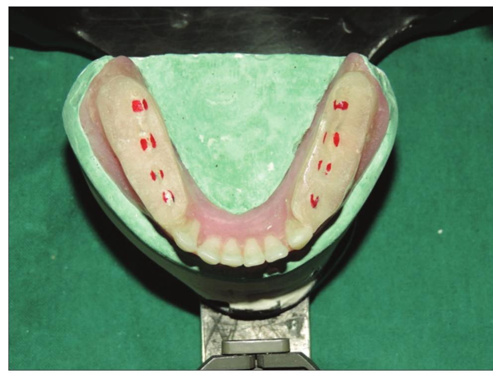Indentation marks on flat occlusal table of mandibular