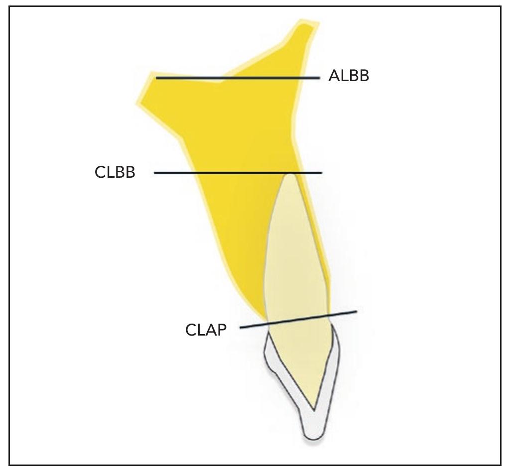 Schematic drawing of a parasagittal reconstruction
