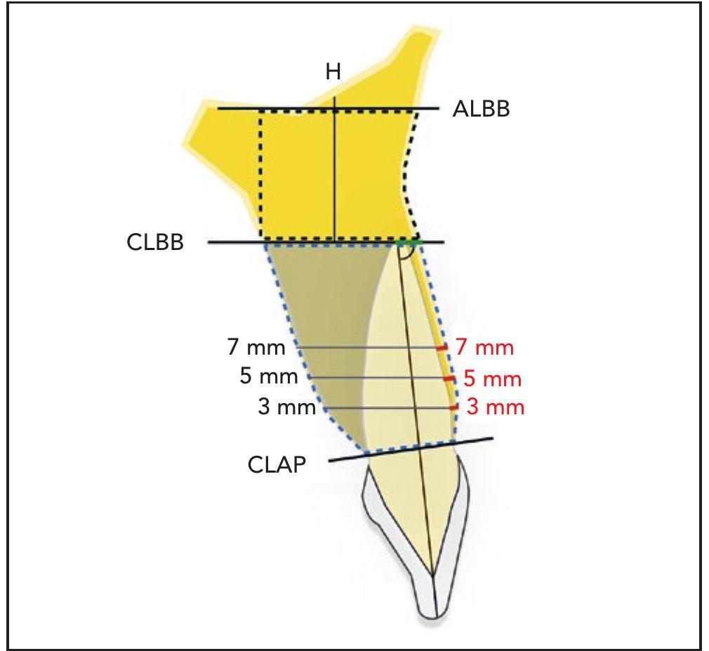 Schematic drawing of a parasagittal reconstruction