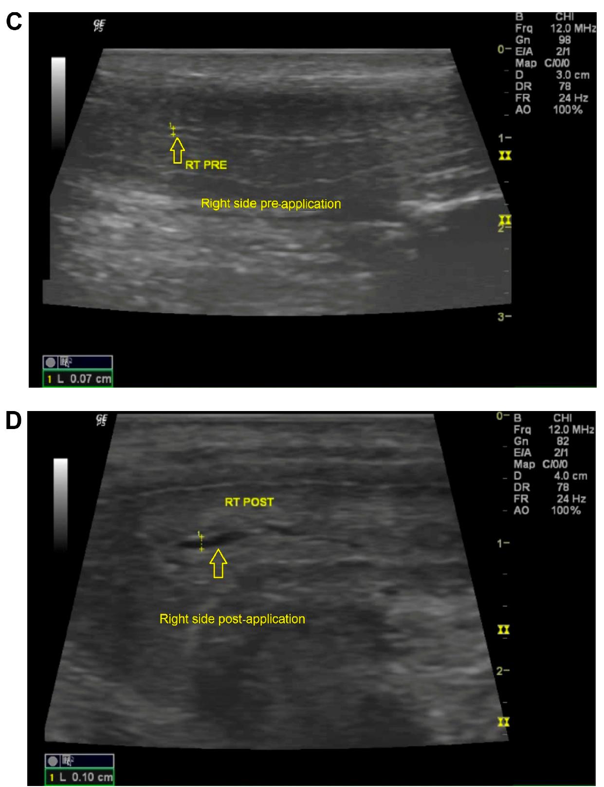 (a) doppler ultrasound image showing the diameter of the