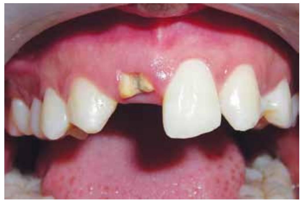 Pretreatment intraoral view: note horizontal root fracture