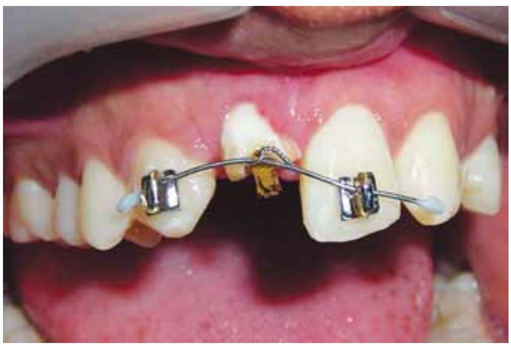 Orthodontic forced eruption procedure carried out with