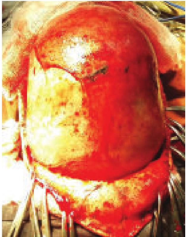 -3: (anterior and posterior flaps were raised in the