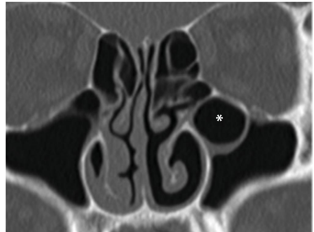 An infraorbital (haller) cell (*) is an anterior or