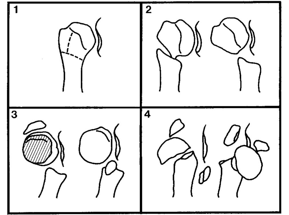 The neer classification of fractures of the surgical neck of