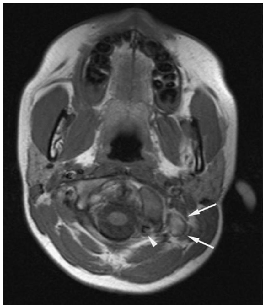 Coronal stir, sagittal t2 and axial t1 images of the neck of