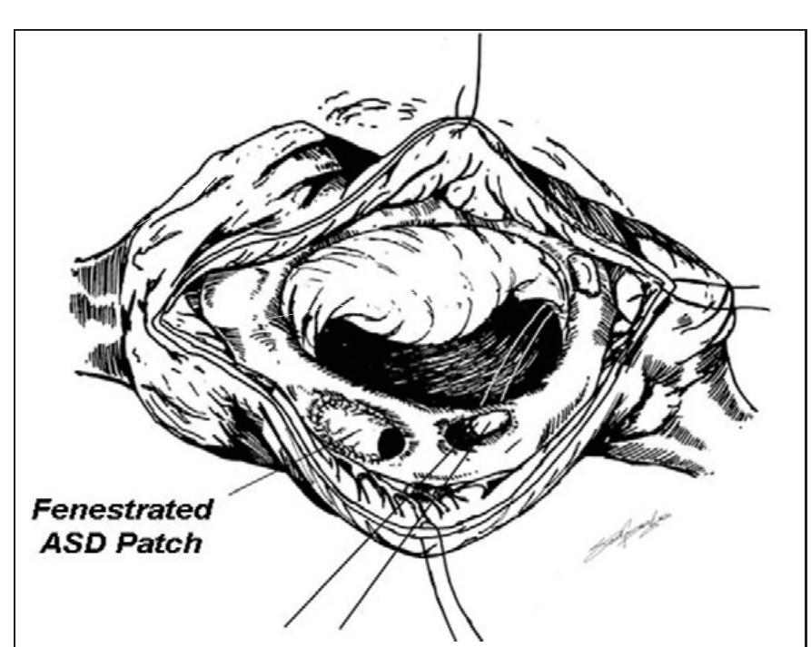 ¢ the atrial septal defect is closed with a fenestrated