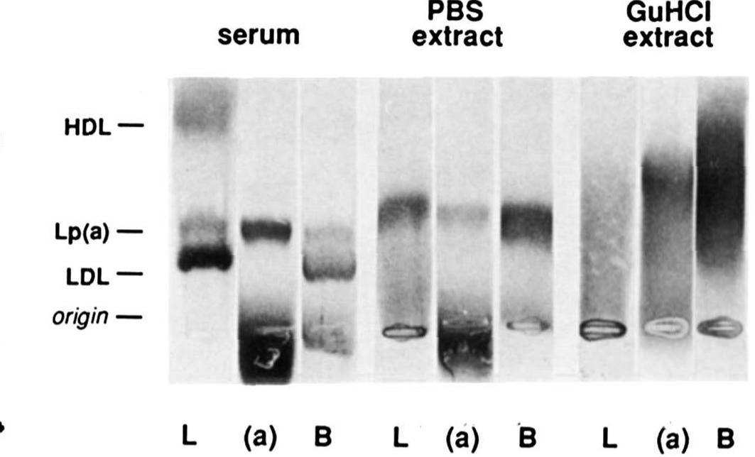 One-dimensional electrophoresis patterns of a plaque pbs ex-