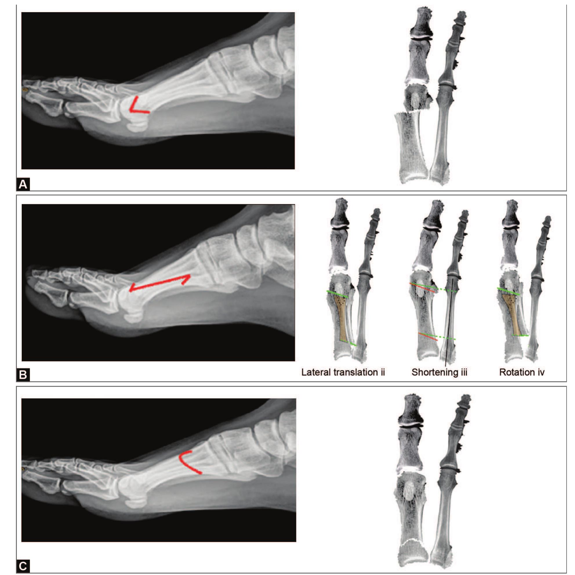 S 3a to c: radiographs and schematic diagrams of different