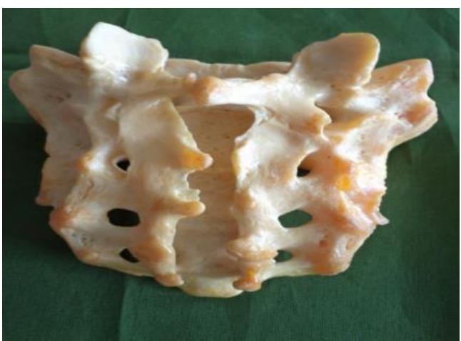 Complete dorsal agenesis of sacrum