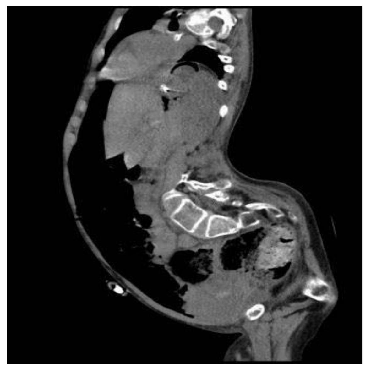 The ct scan (sagittal view) showing the same finding in