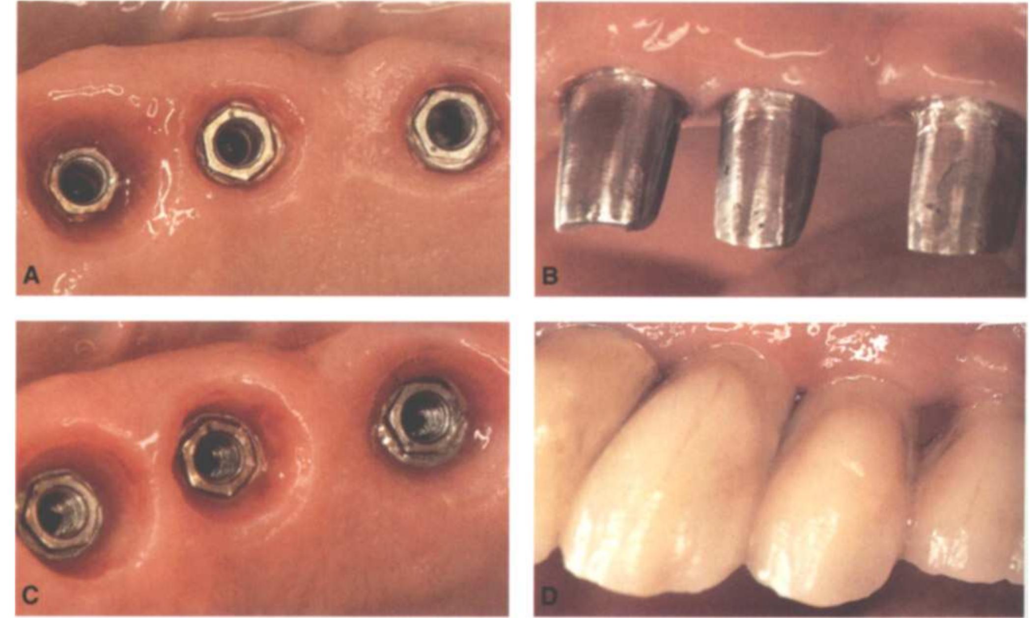 A, maxillary left posterior quadrant following removal of