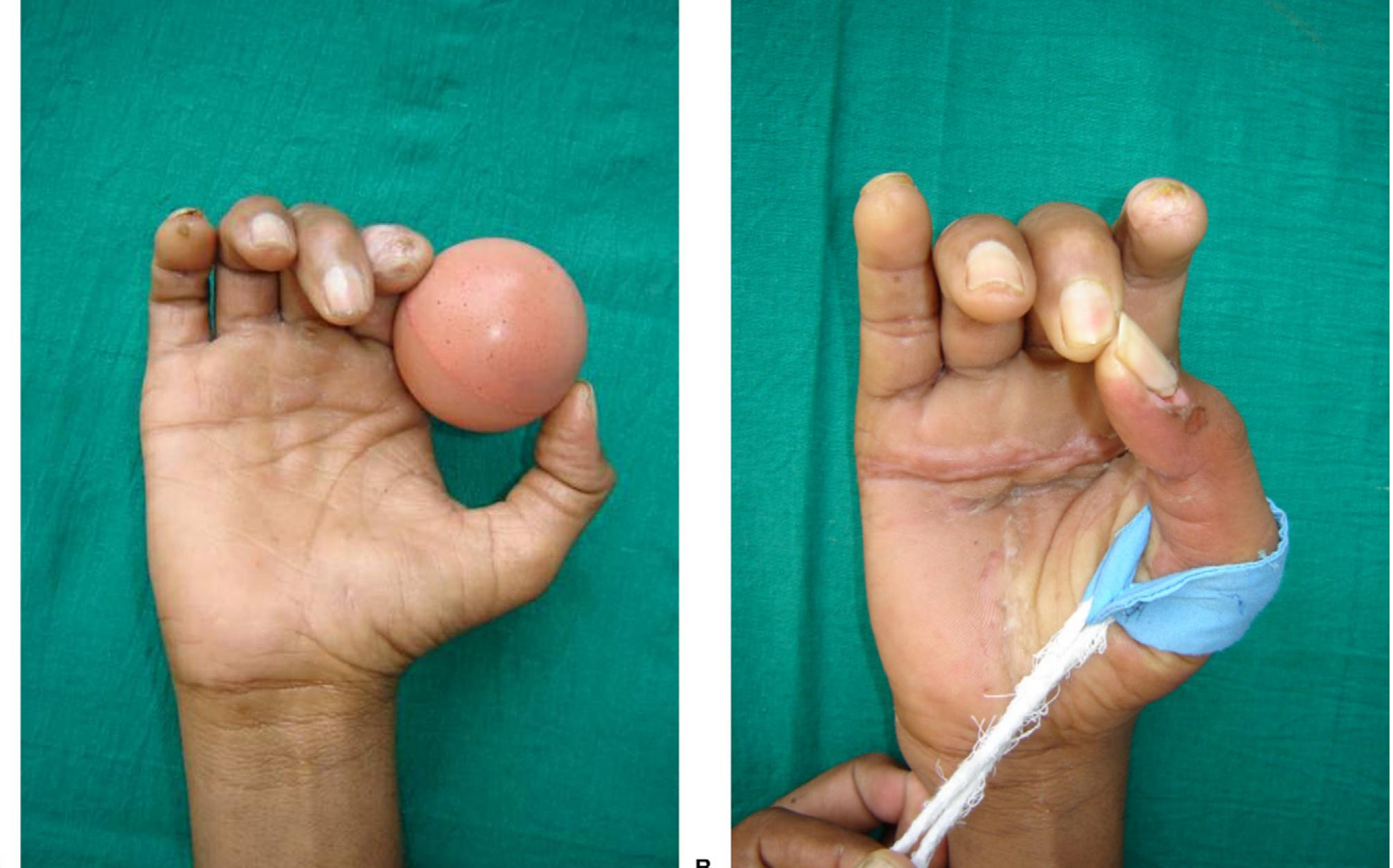 A thumb deformity in combined median ulnar nerve paralysis.