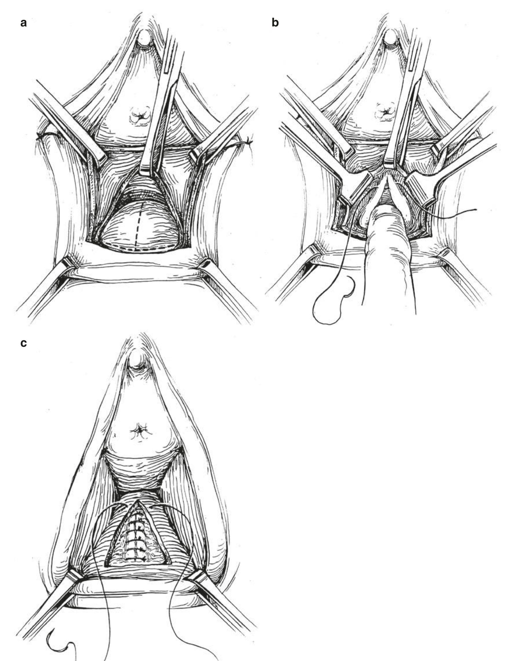 Figure 4 - Pelvic Organ Prolapse and Perineal Hernias