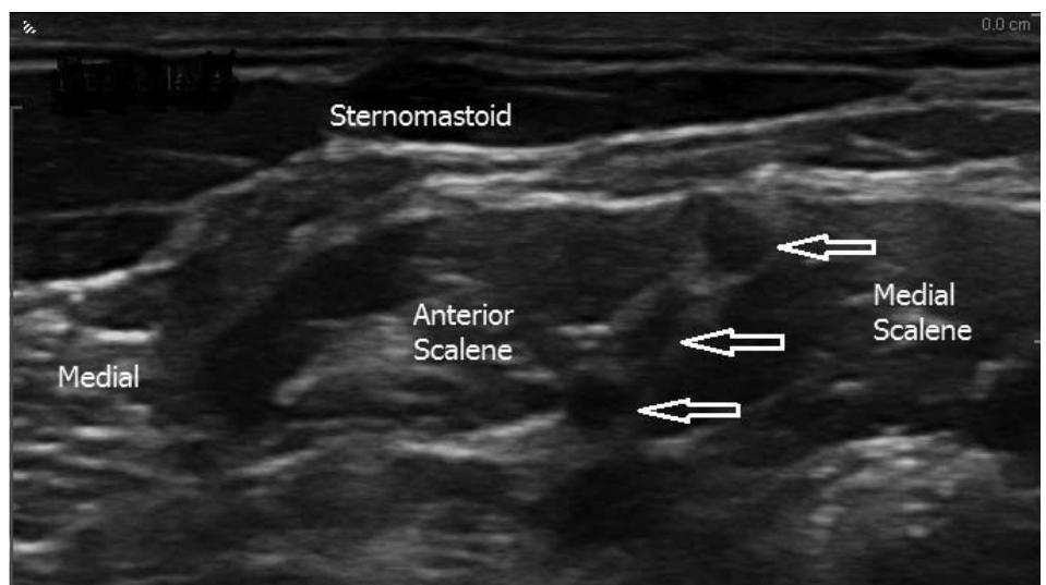 Sonoanatomy at interscalene level. note the ‘traffic light’