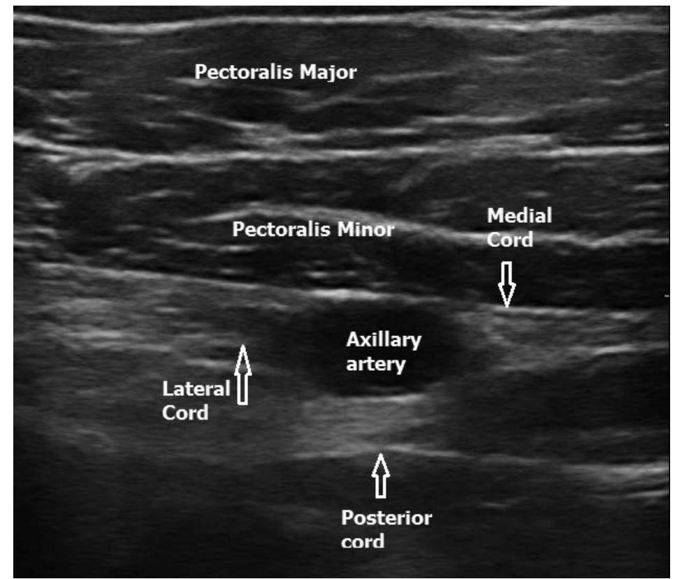 Sonoanatomy at the infraclavicular level. the cords are