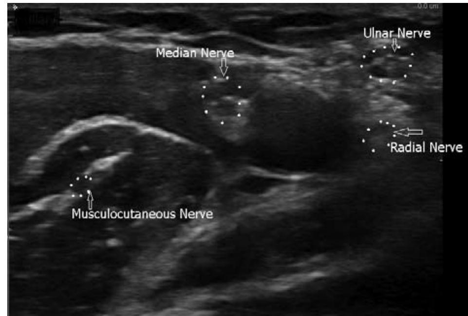 Sonoanatomy at axillary level. the relation to axillary