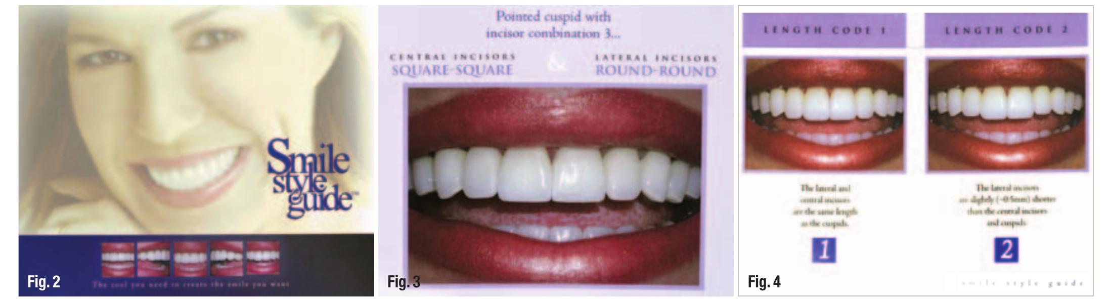 Because her maxillary six anteriors had worn, flat incisal