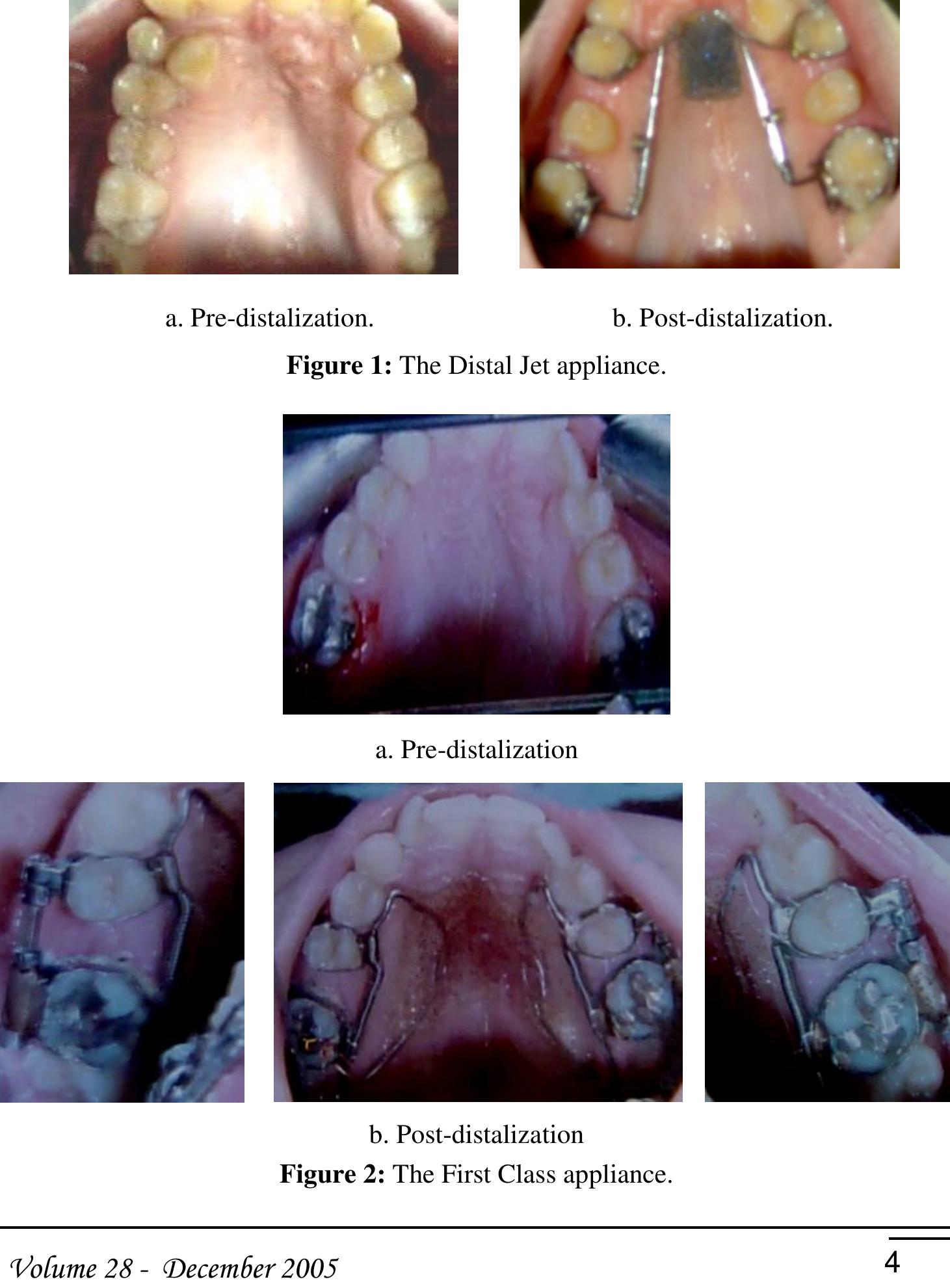 Wires to the first premolars in the distal jet appliance