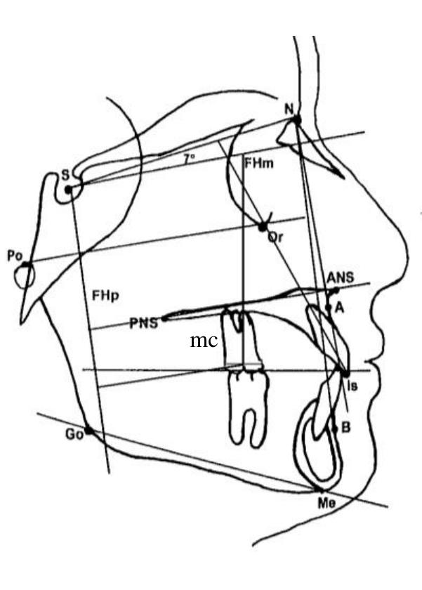 Figure 4 - Distal jet versus first class appliance for