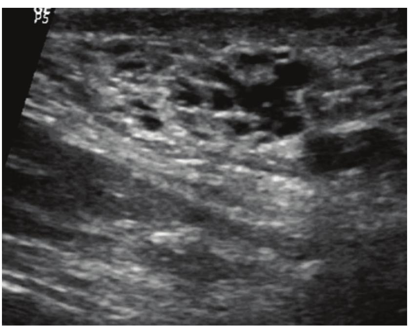 -6: usg images shows anechoic tubular channels in the