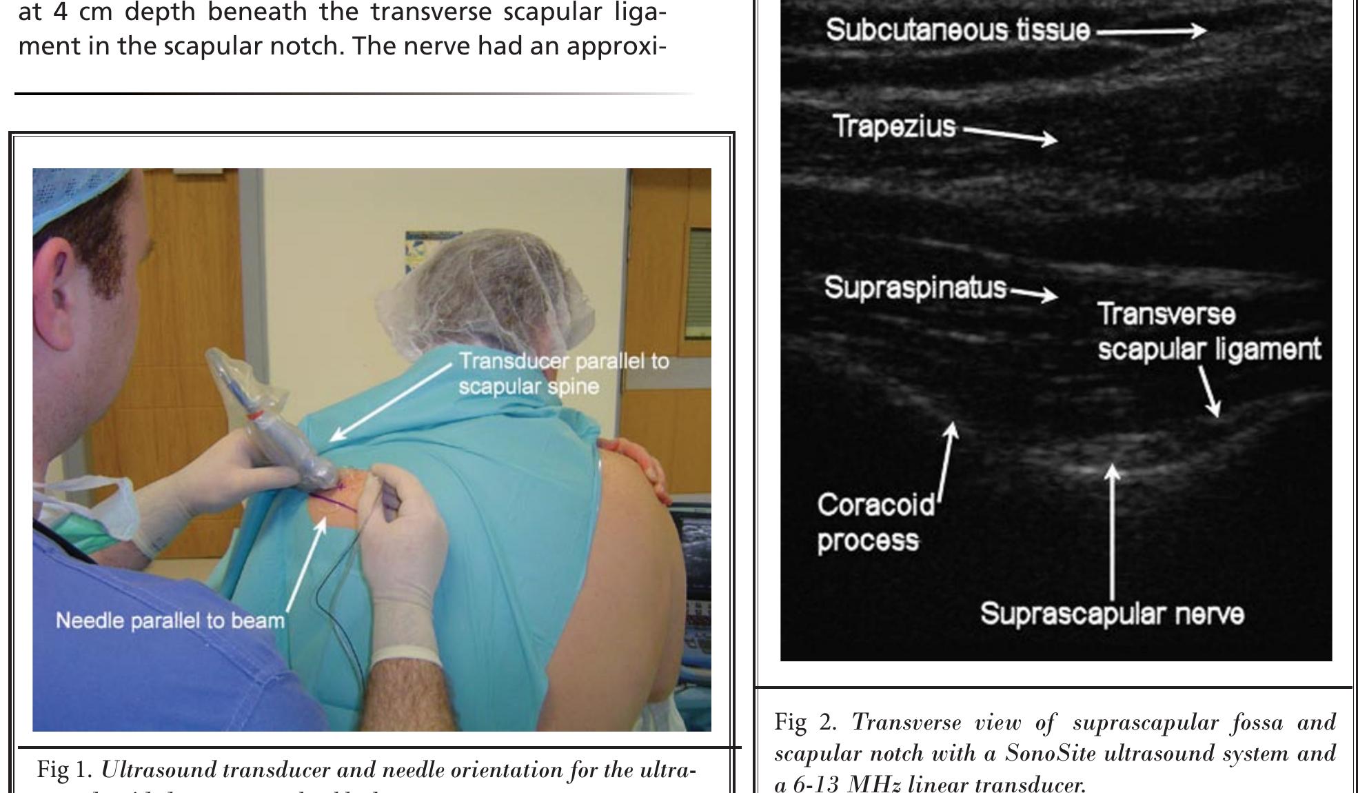 Figure 1 - Ultrasound-guided suprascapular nerve block