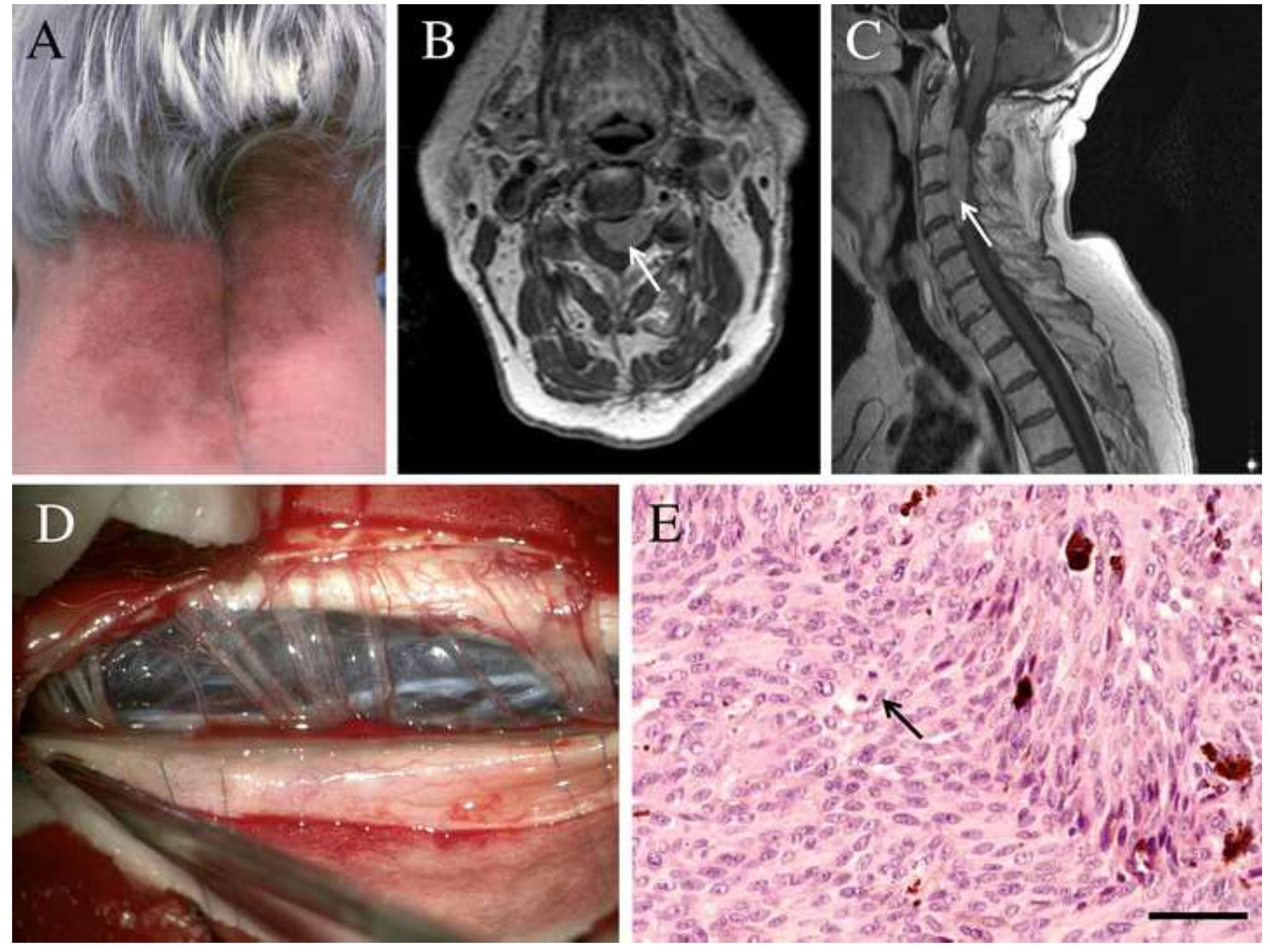 Figure 1 - Whole-exome sequencing of a meningeal melanocytic Figure 1 - Whole-exome sequencing of a meningeal melanocytic