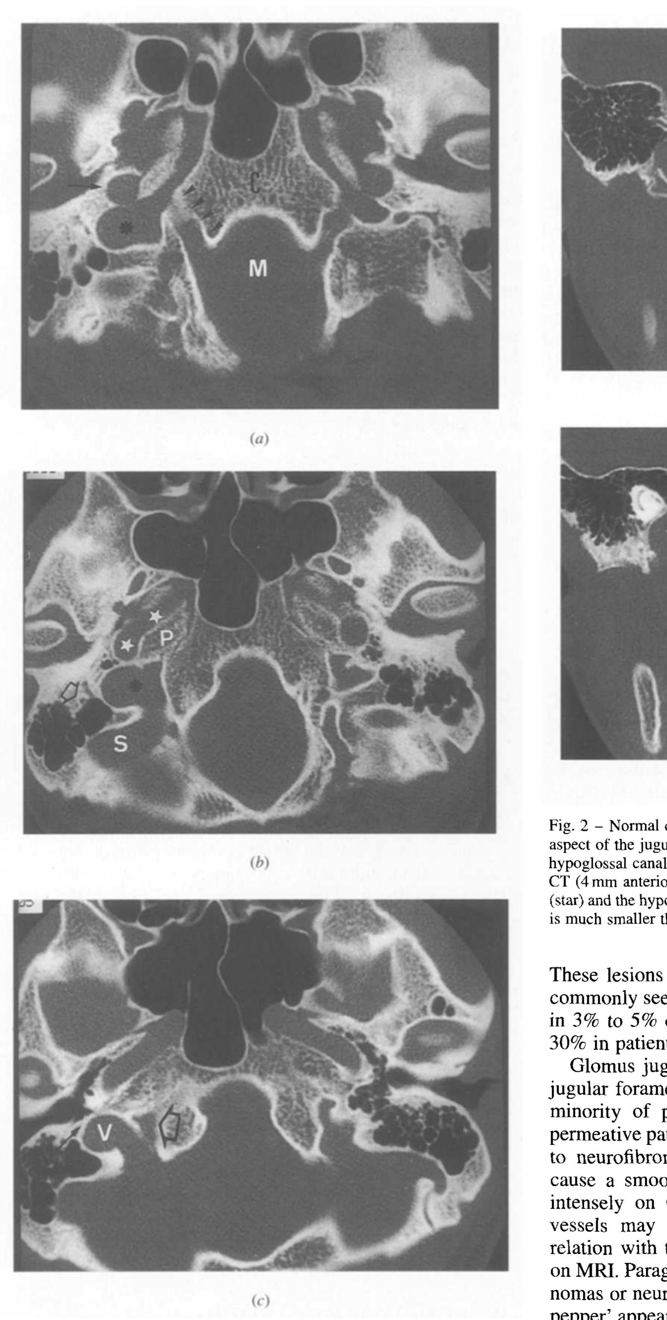 normal axial anatomy. (a) axial ct shows the exocranial
