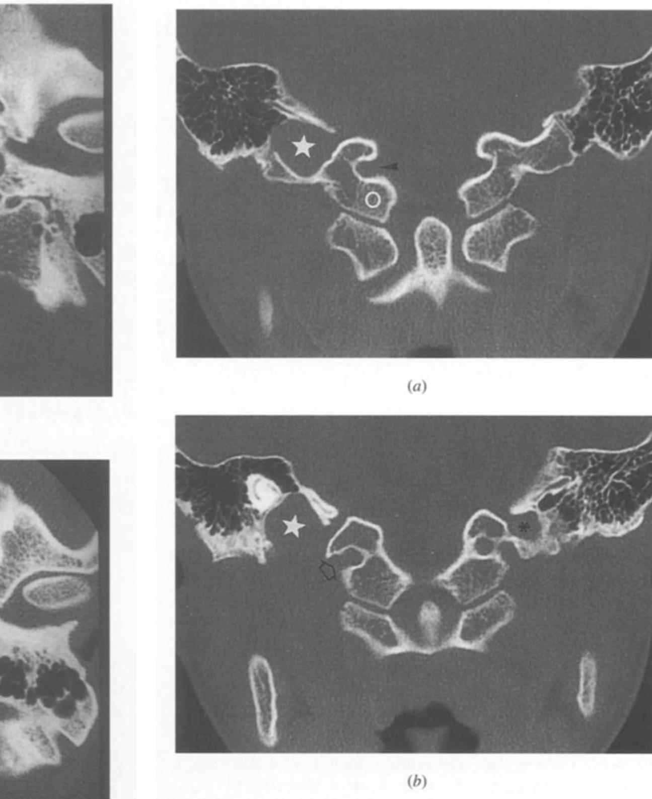 normal coronal anatomy. (a) coronal ct shows the