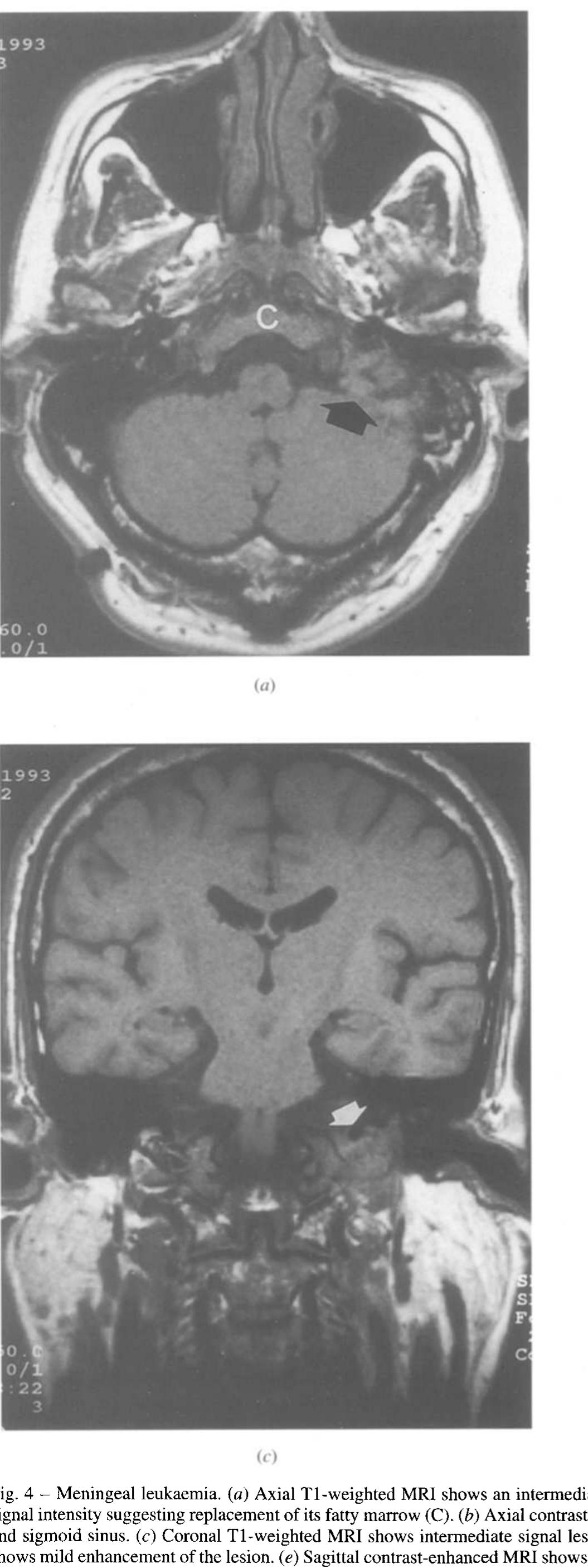 Figure 4 - Pictorial review: Radiology of the jugular